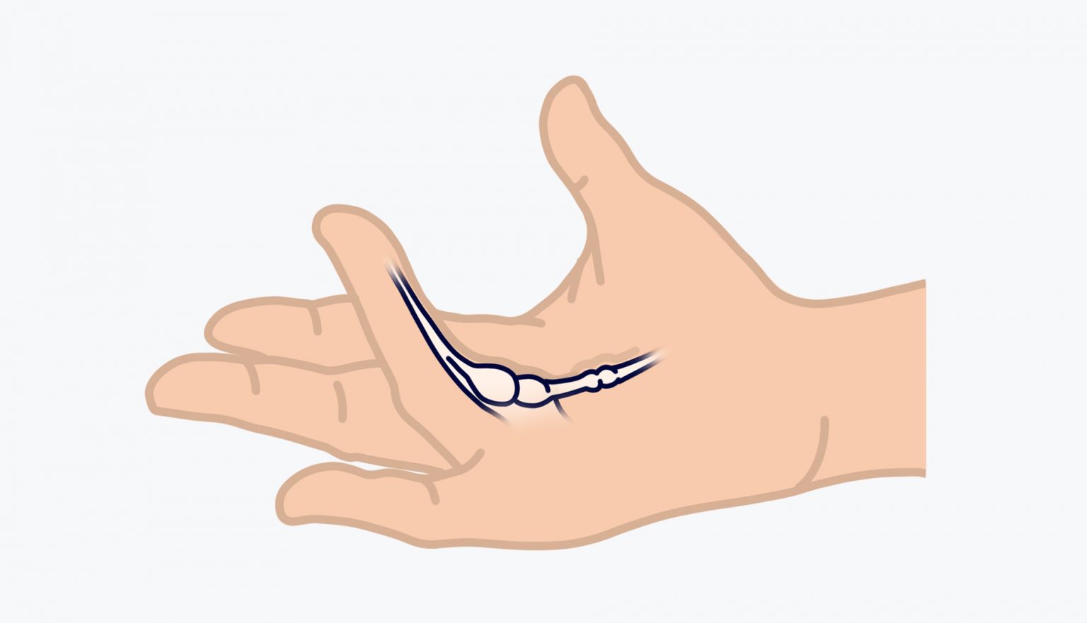 Morbus Dupuytren: Ursachen, Symptome und Behandlung der Dupuytren ...