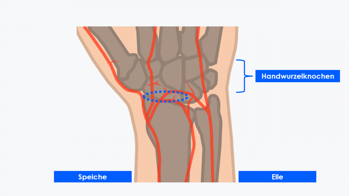 Kahnbeinfraktur: Die 7 wichtigsten Themen bei einem Bruch im Handgelenk ...