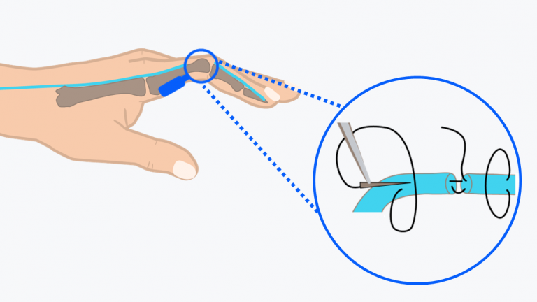 Strecksehne im Finger gerissen: Das musst du jetzt wissen - LIME ...